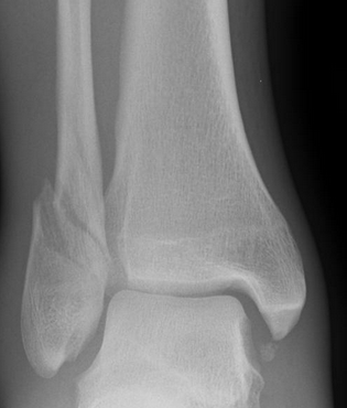 weber b - Critical Care Practitioner