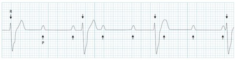 Heart Block - Critical Care Practitioner