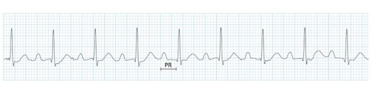 Heart Block - Critical Care Practitioner